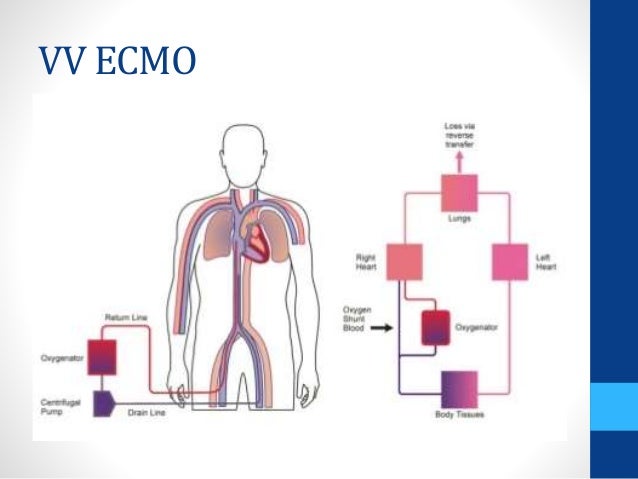 ECMO for Cardiac Arrest