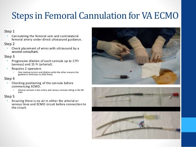 ECMO for Cardiac Arrest