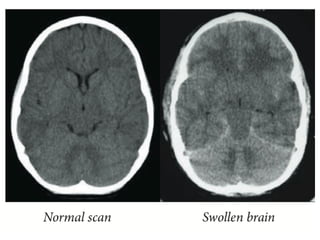 Emergency in neurology | PDF