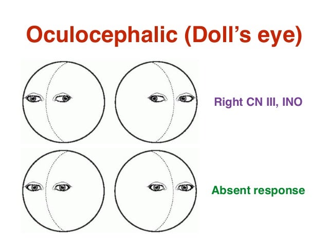 Emergency in neurology
