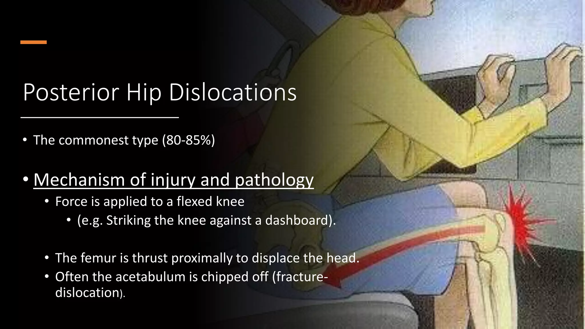 Emergency management of common dislocations | PPTX