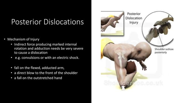 Emergency management of common dislocations | PPTX