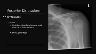 Emergency management of common dislocations | PPTX
