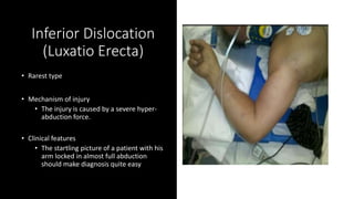 Emergency management of common dislocations | PPTX