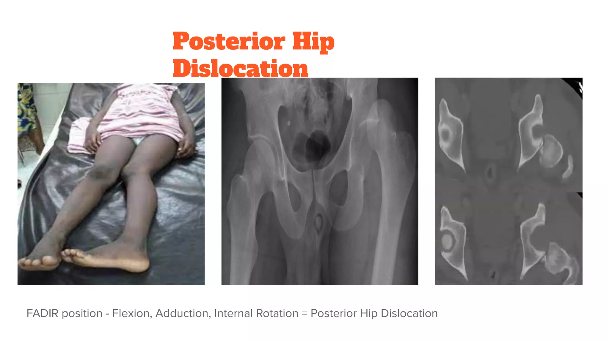 Emergency Management of Hip Dislocations & Pelvic Fractures.pdf