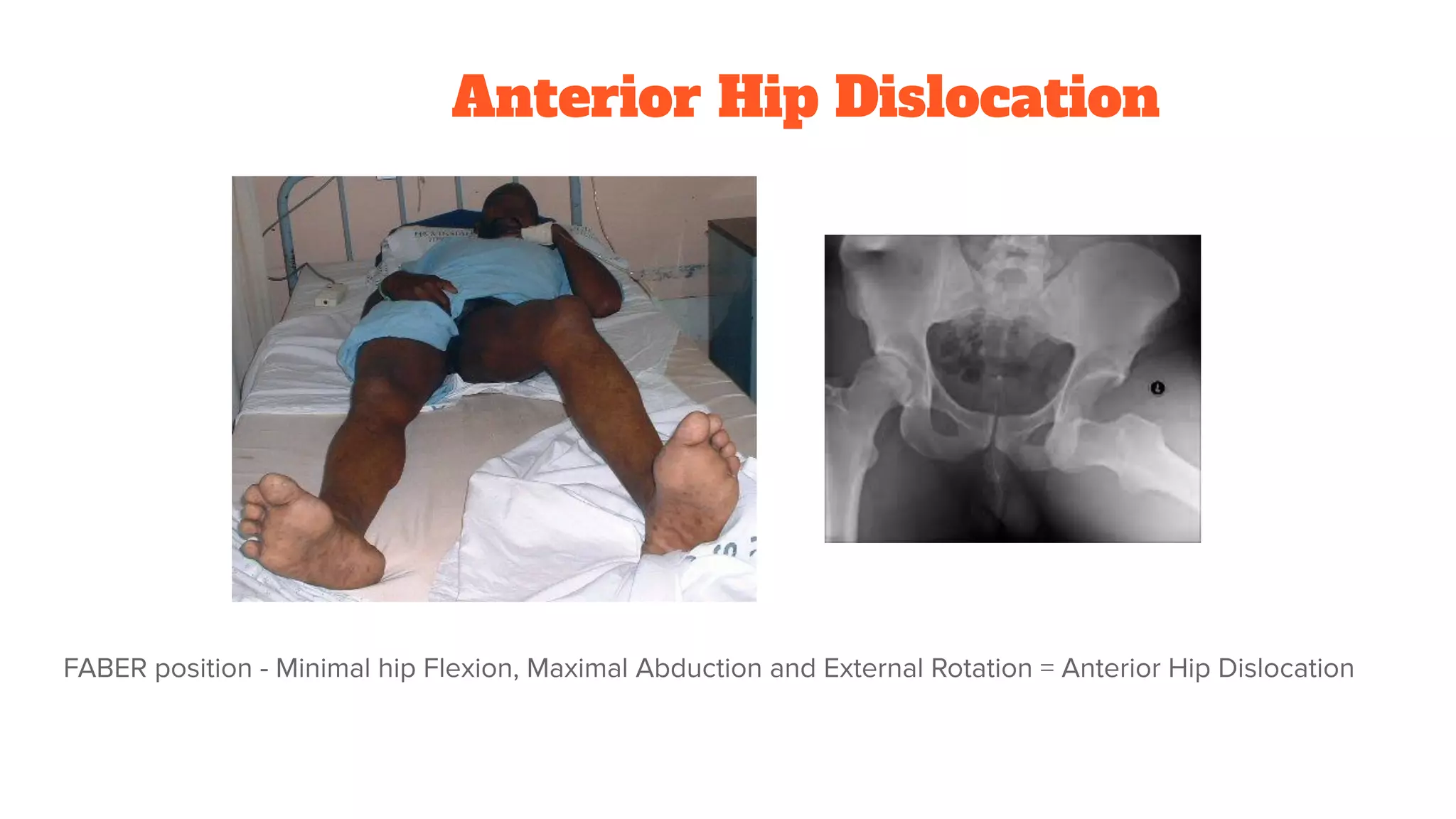 Emergency Management of Hip Dislocations & Pelvic Fractures.pdf