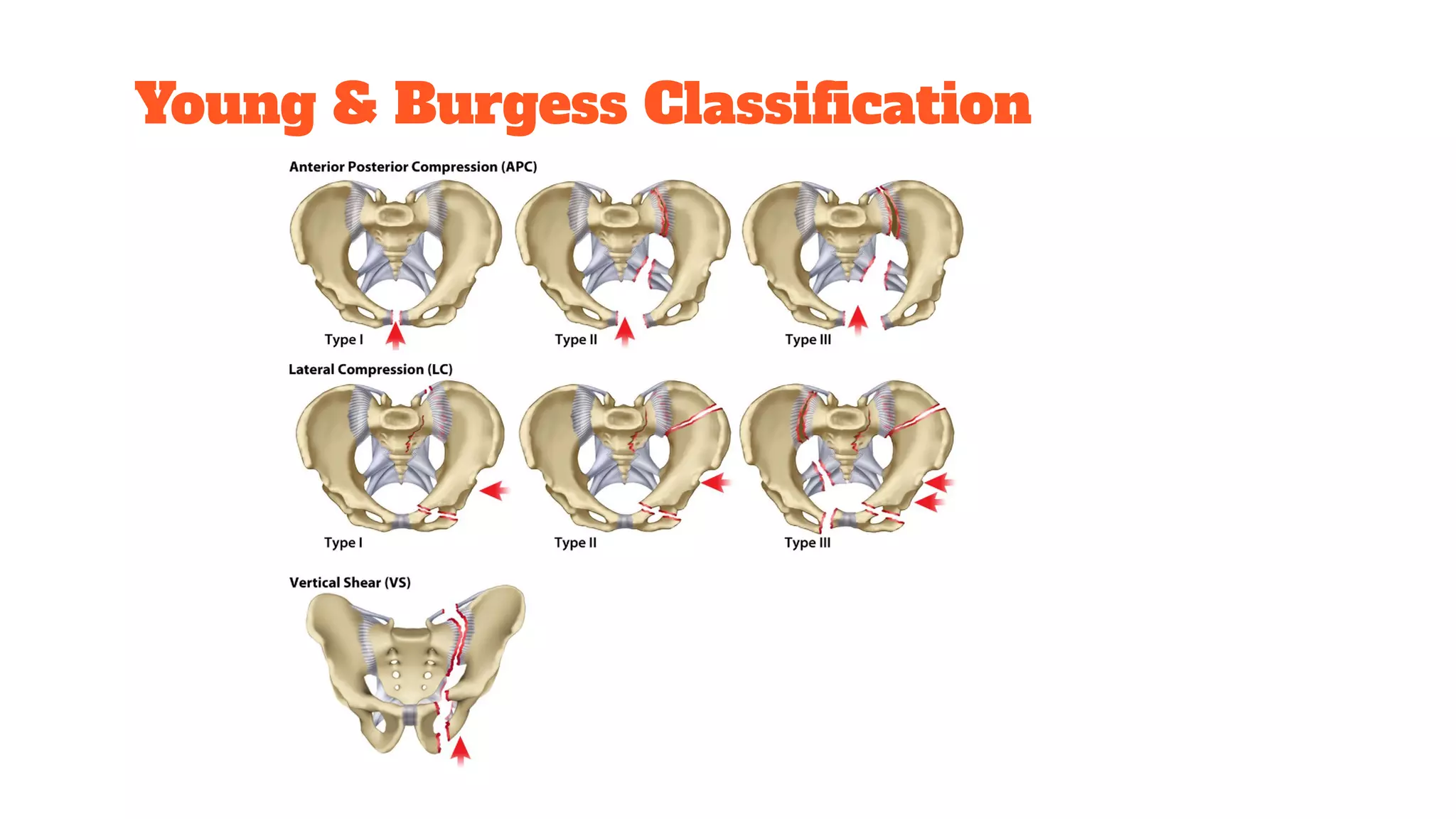 Emergency Management of Hip Dislocations & Pelvic Fractures.pdf