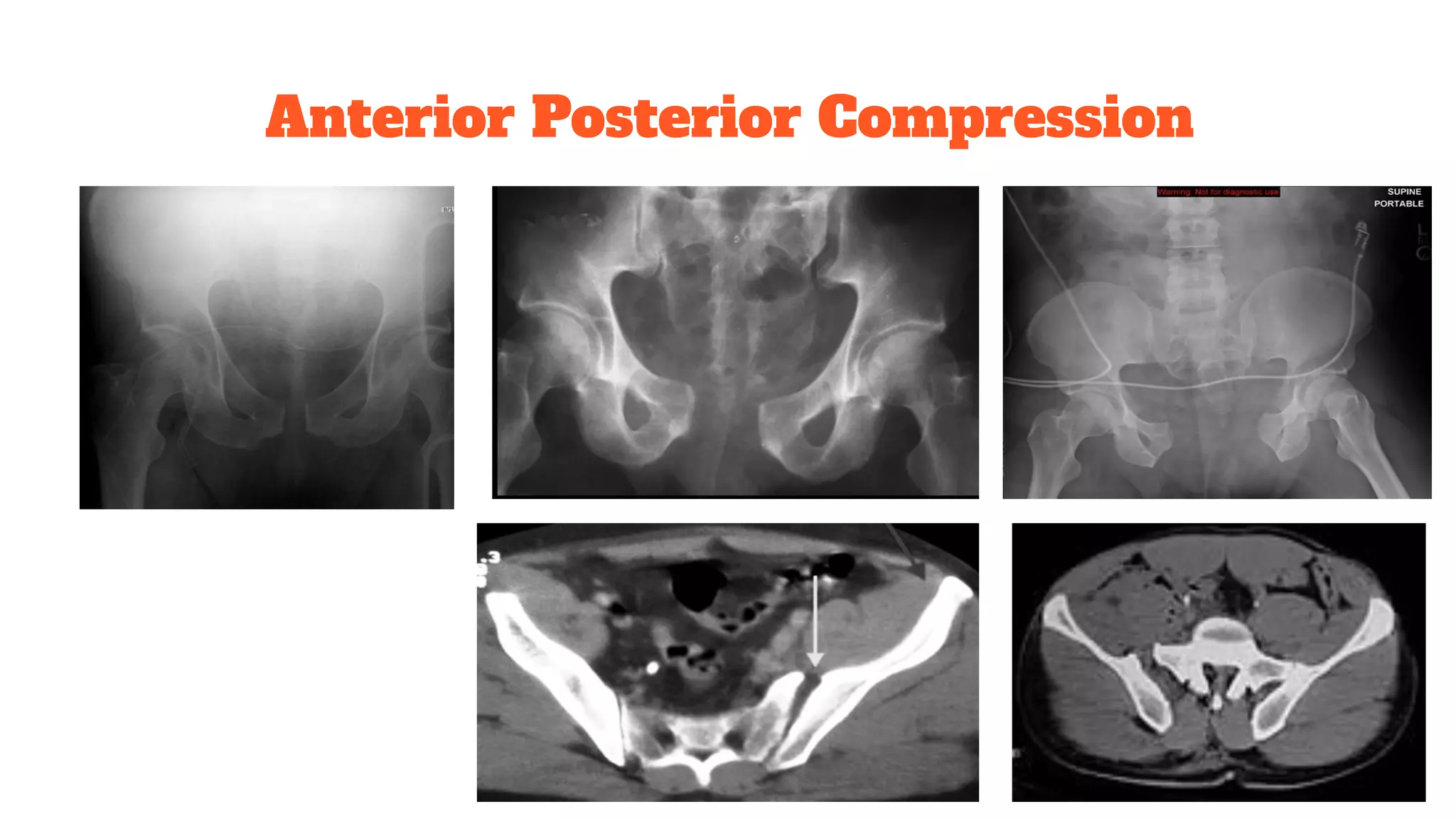Emergency Management of Hip Dislocations & Pelvic Fractures.pdf