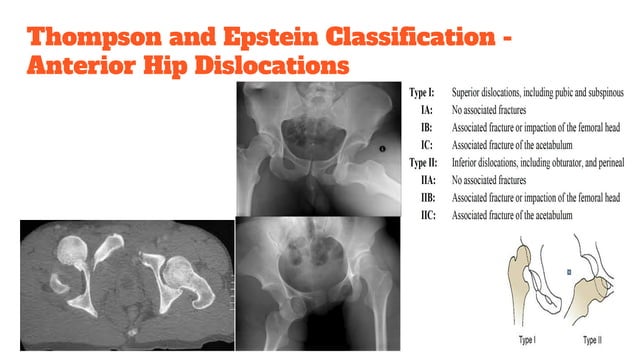 Emergency Management of Hip Dislocations & Pelvic Fractures.pdf