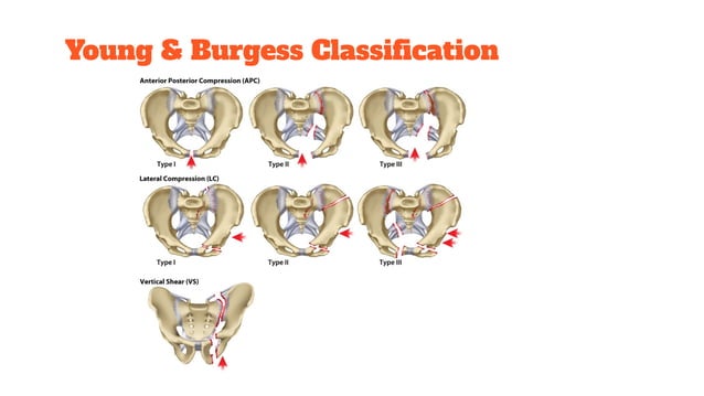 Emergency Management of Hip Dislocations & Pelvic Fractures.pdf