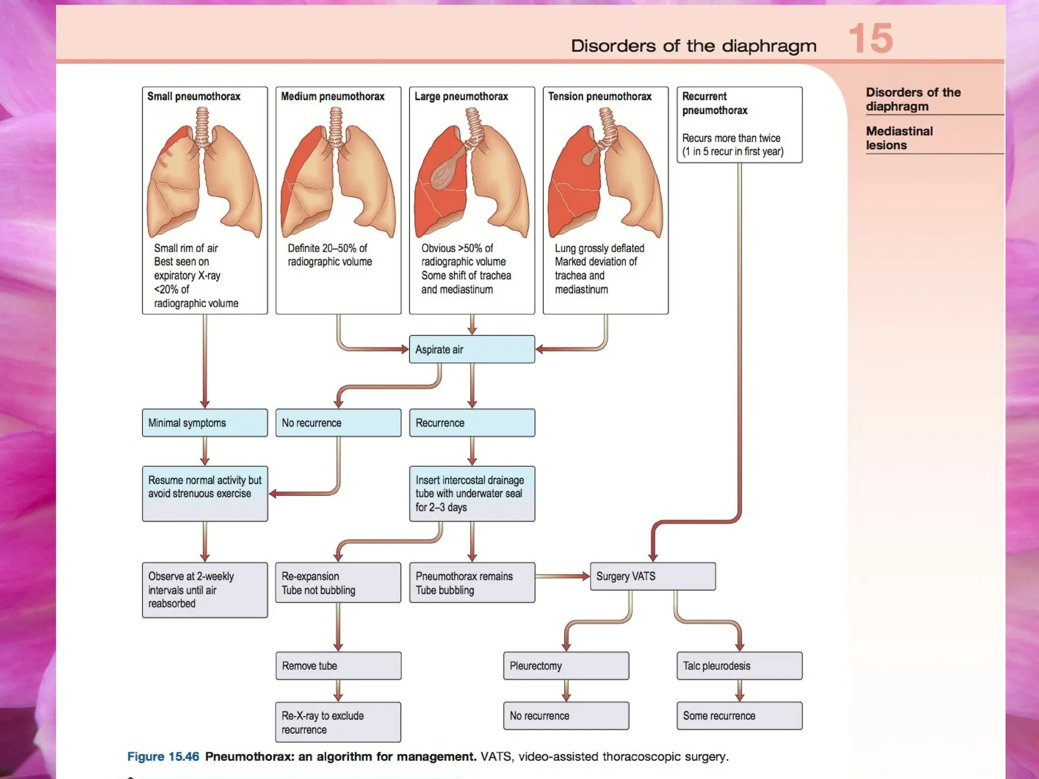 Emergency Management of Pneumothorax pptx 2.pptx