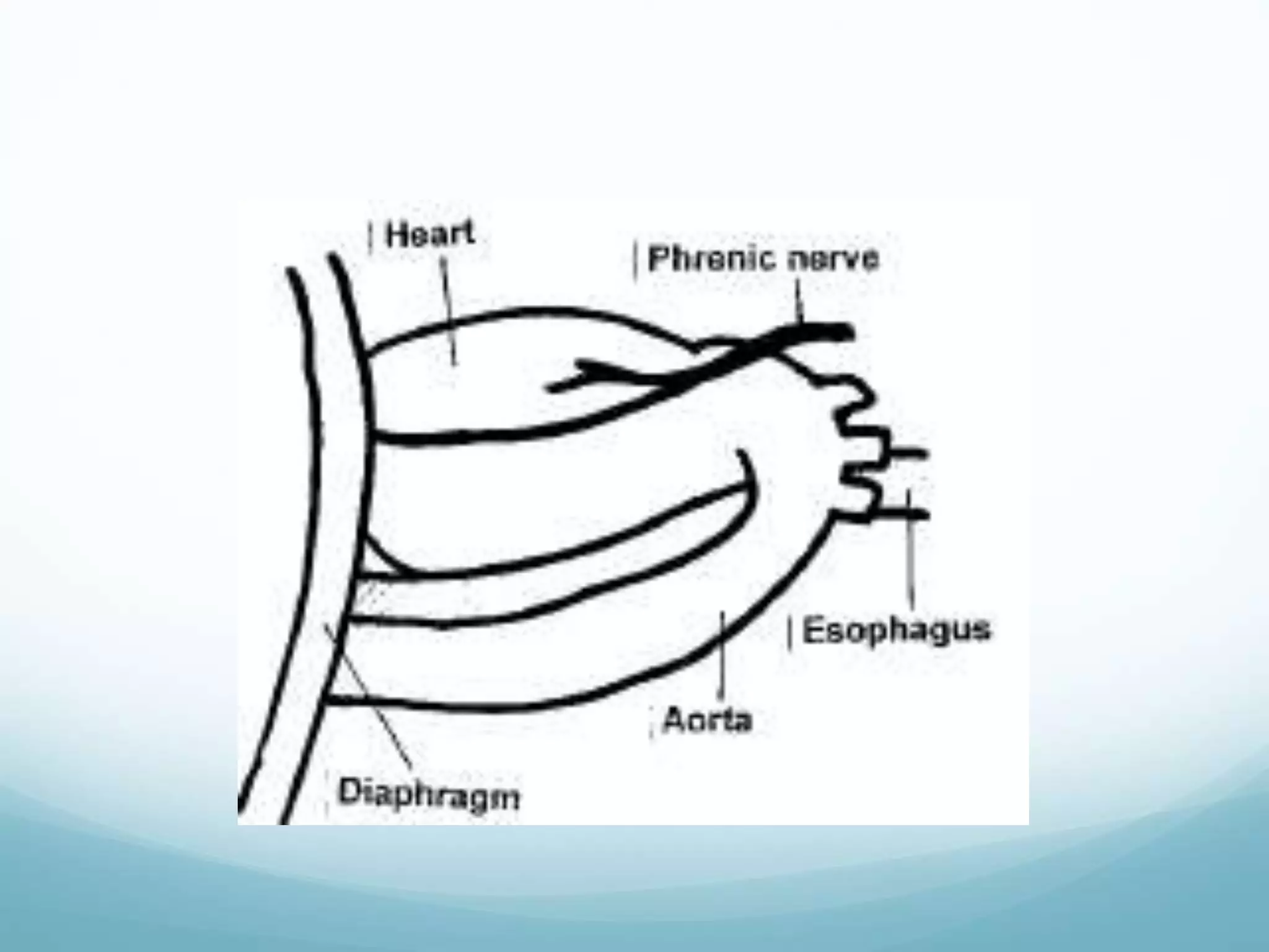 Emergency Thoracotomy | PPTX