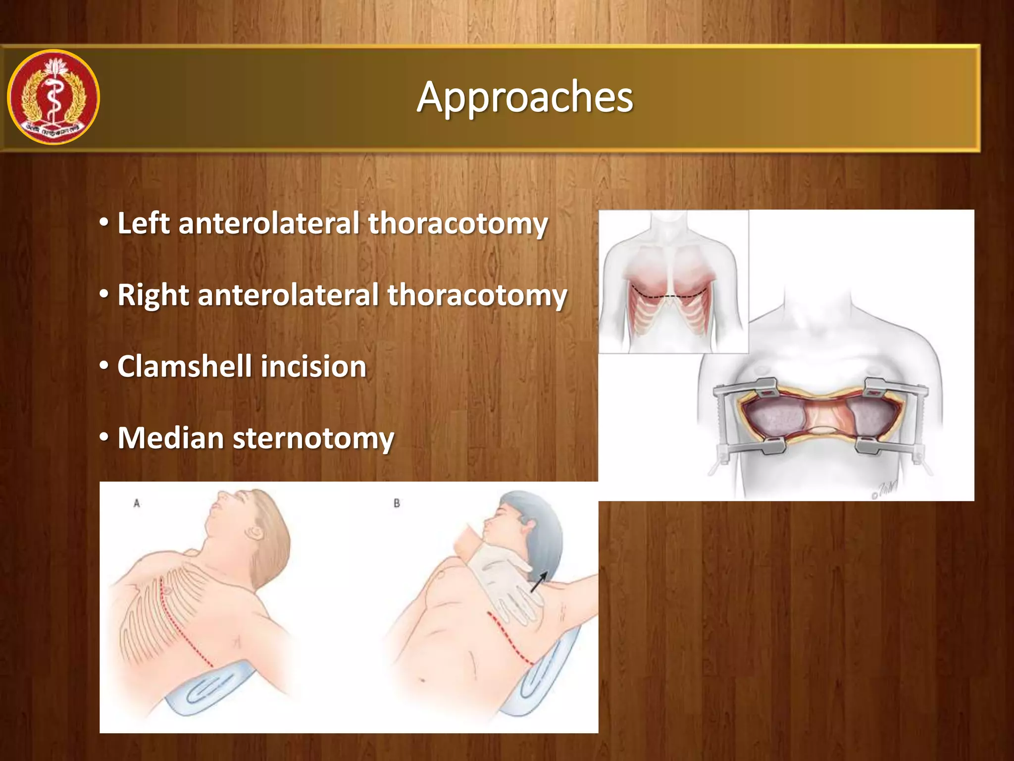 Emergency Thoracotomy | PPT