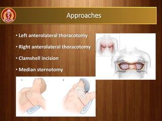 Emergency Thoracotomy | PPT