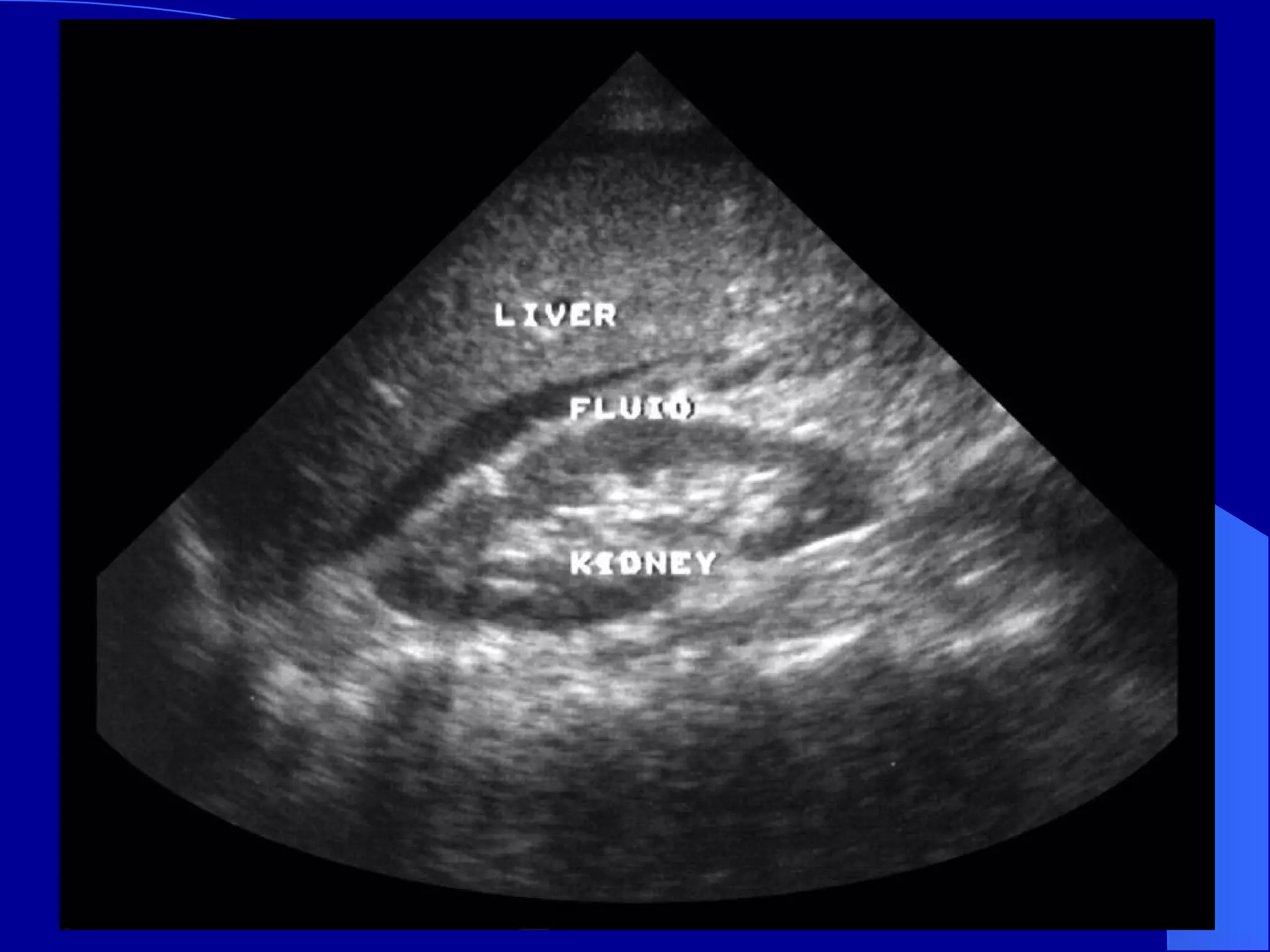 Emergency Ultrasound In Trauma | PPT