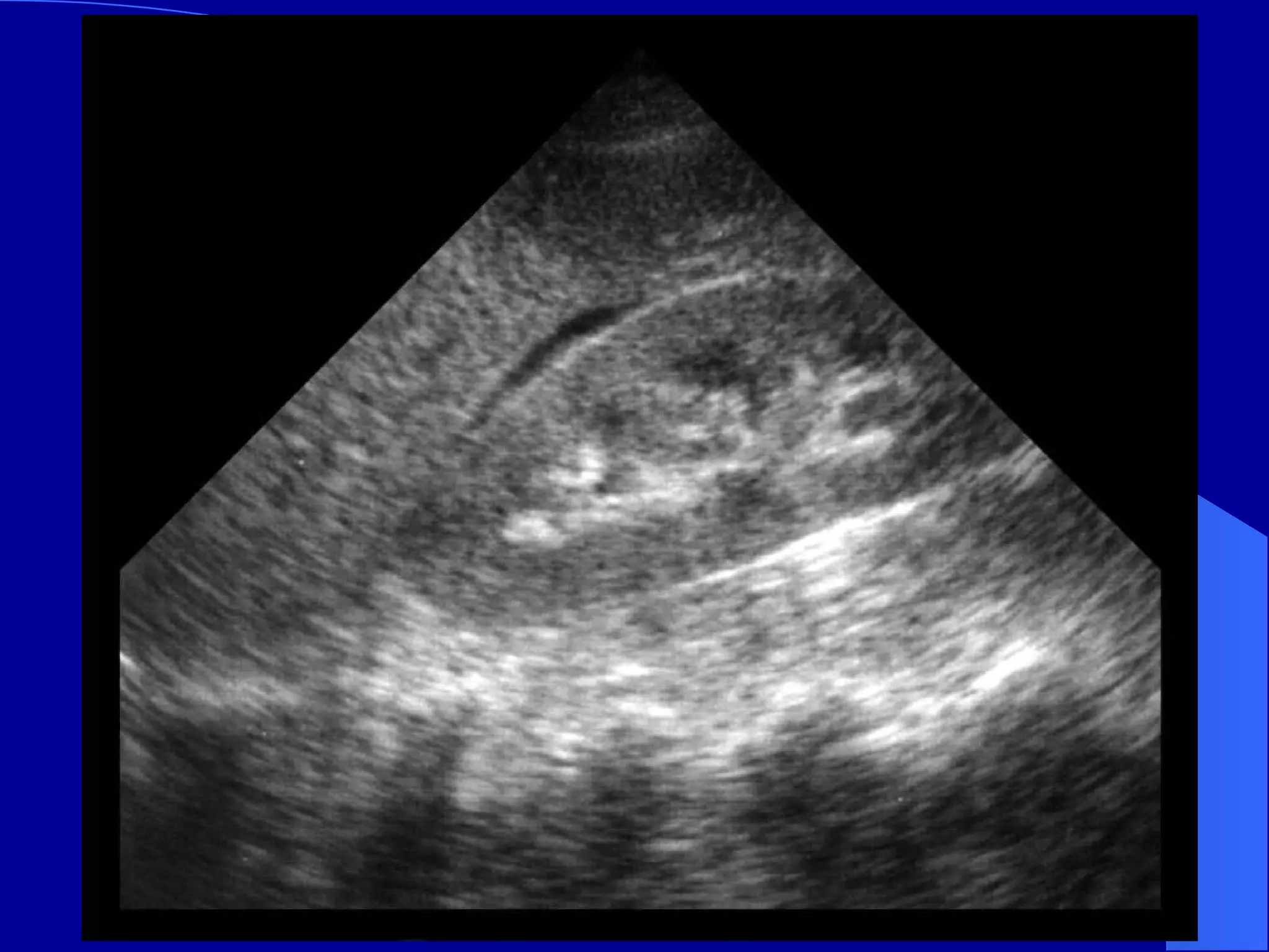 Emergency Ultrasound In Trauma | PPT