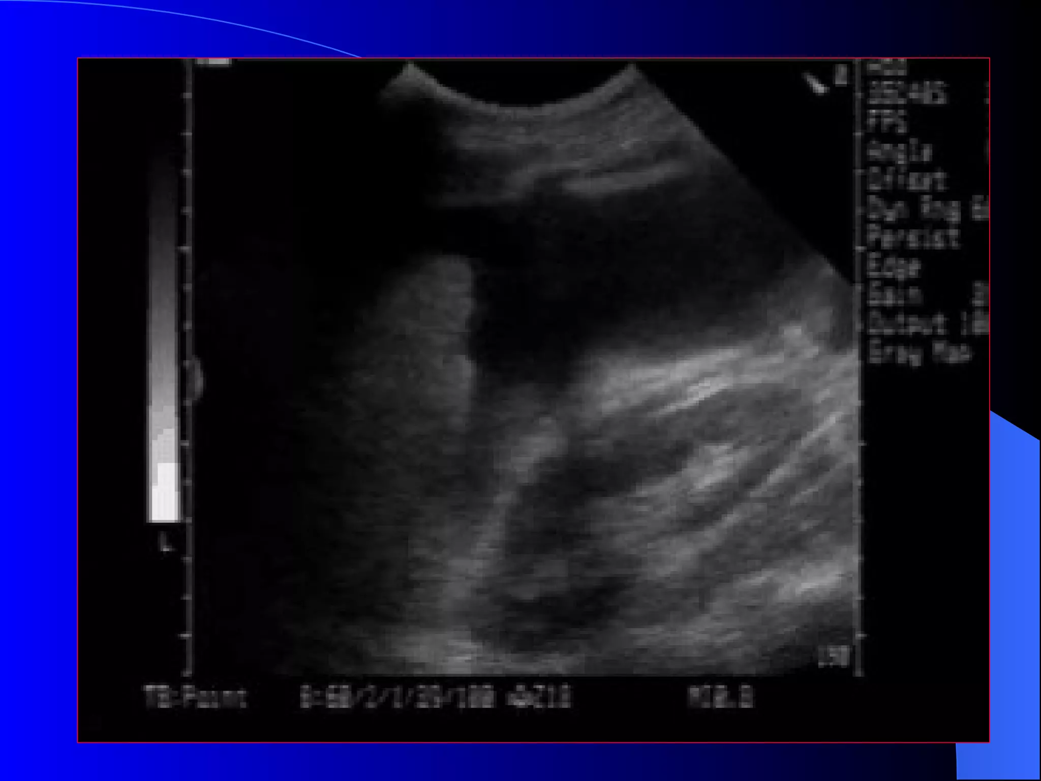 Emergency Ultrasound In Trauma | PPT