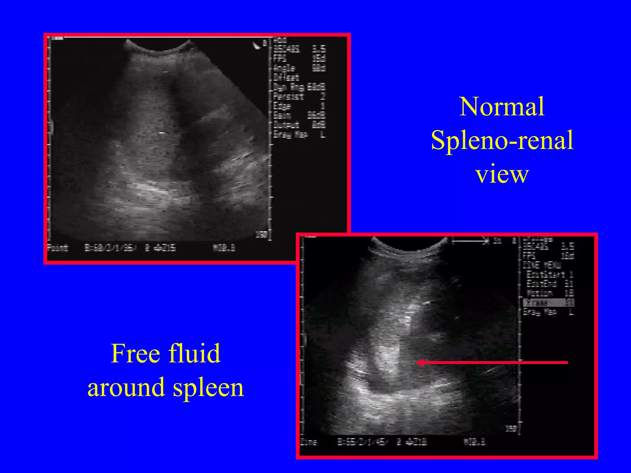 Emergency Ultrasound In Trauma | PPT