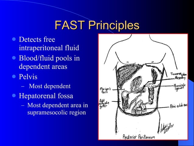 Emergency Ultrasound In Trauma | PPT | First Aid | Injuries