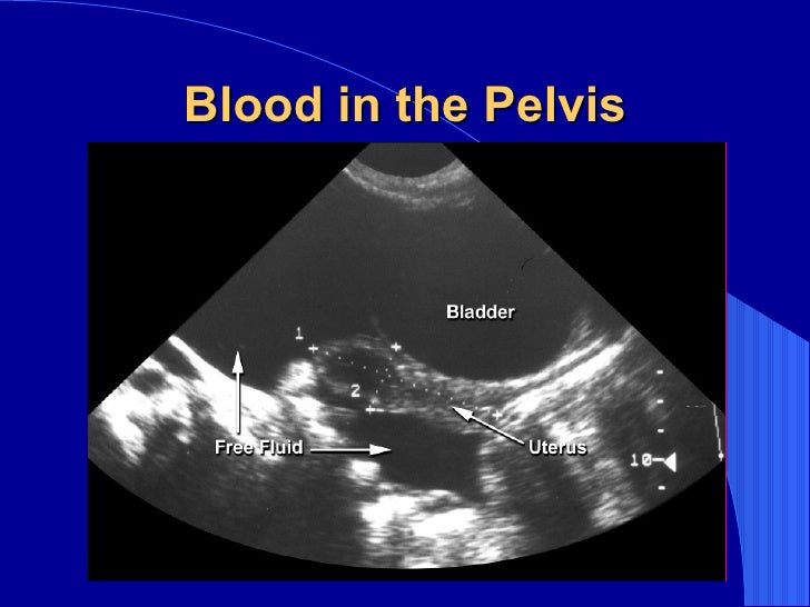 Emergency Ultrasound In Trauma