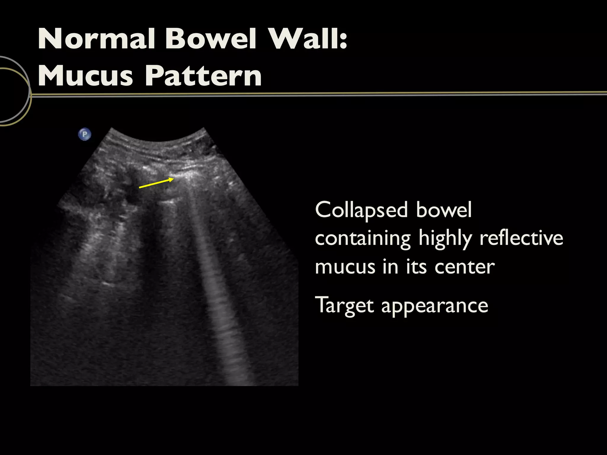 Emergency Ultrasound: Bowel | PDF