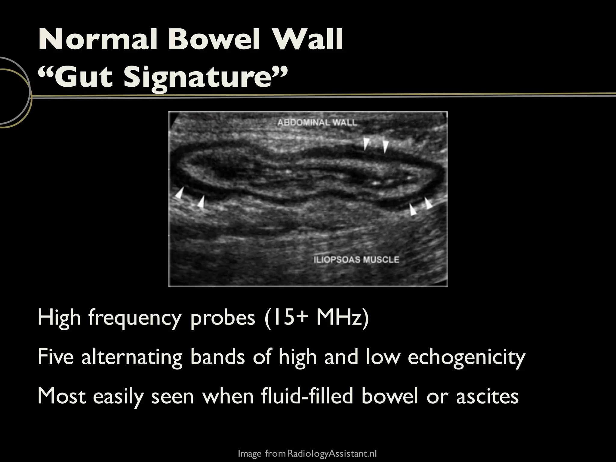 Emergency Ultrasound: Bowel | PDF
