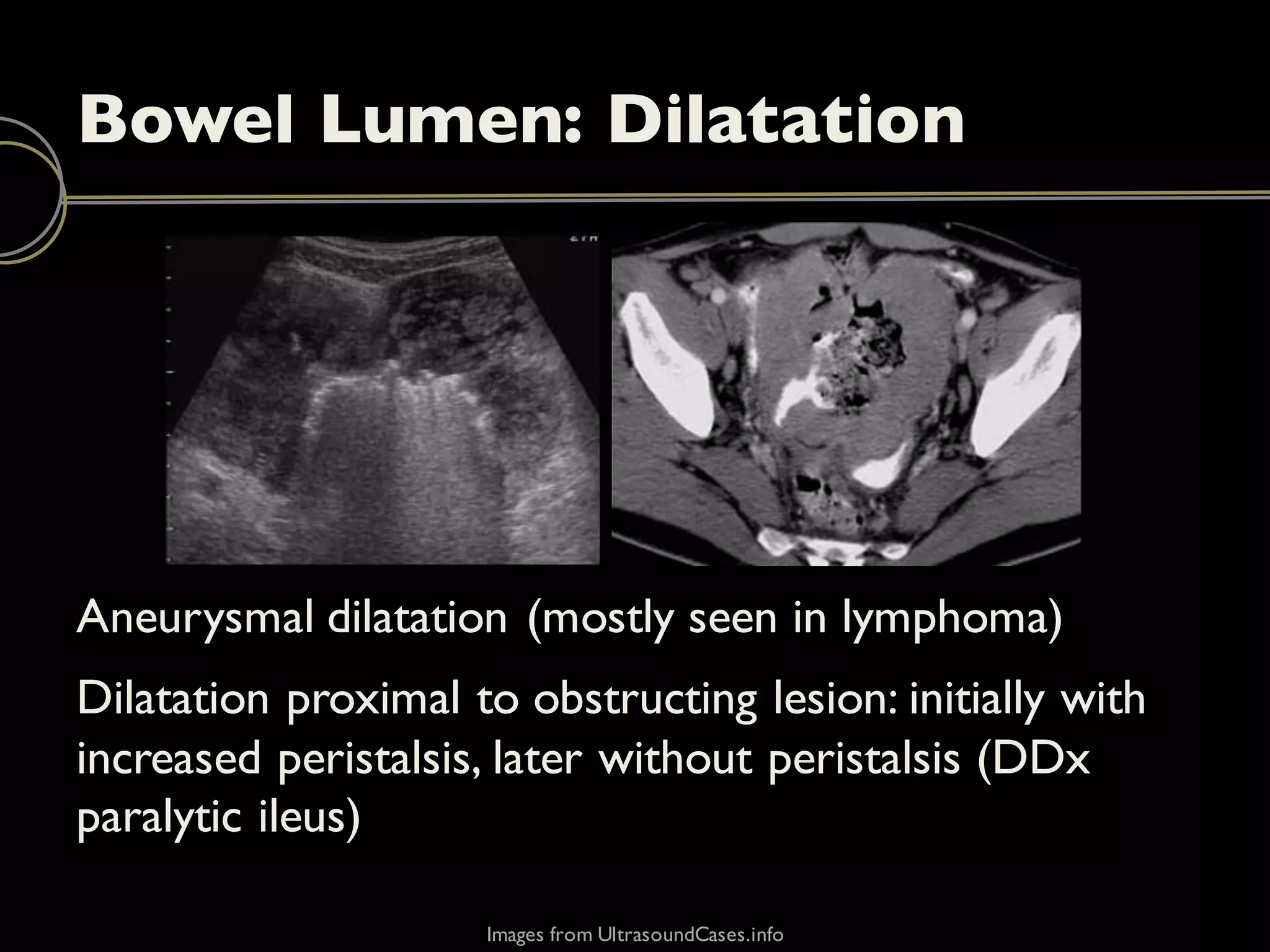 Emergency Ultrasound: Bowel | PDF