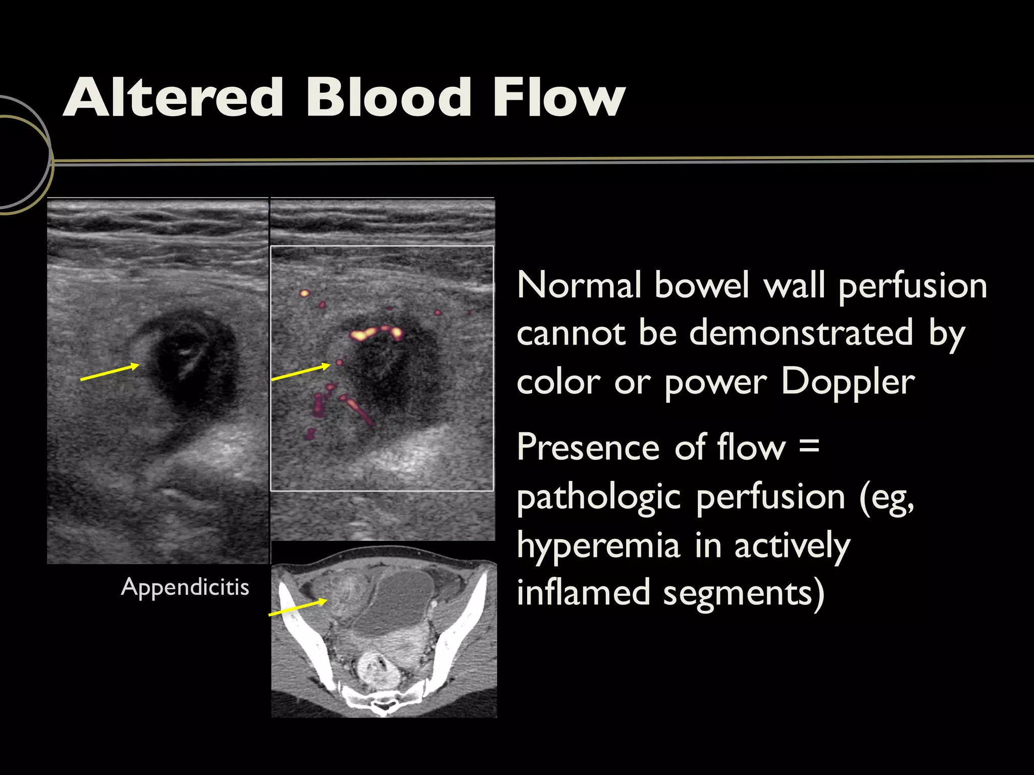 Emergency Ultrasound: Bowel | PDF
