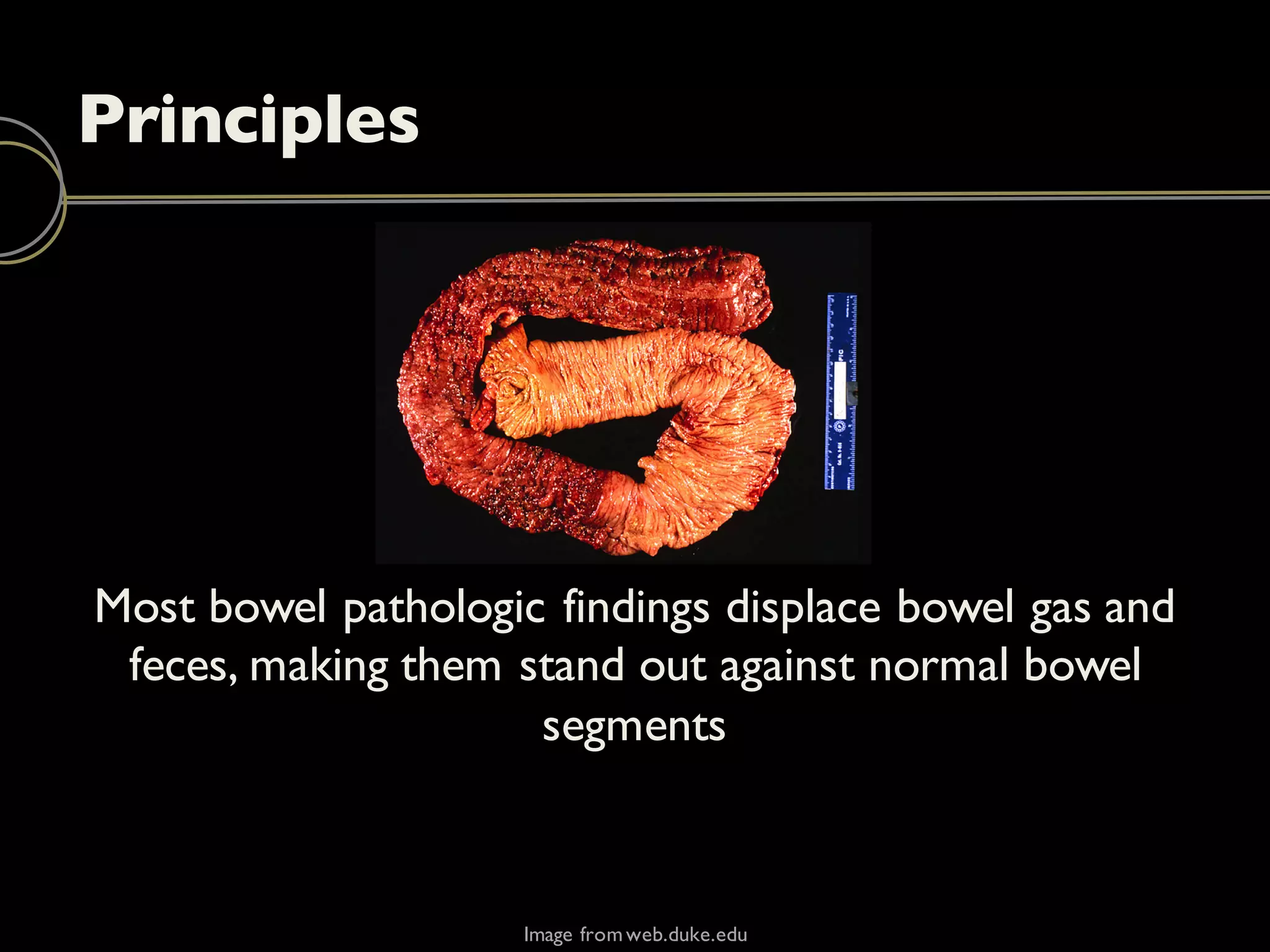 Emergency Ultrasound: Bowel | PDF