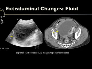 Emergency Ultrasound: Bowel | PDF