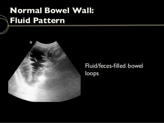 Emergency Ultrasound: Bowel