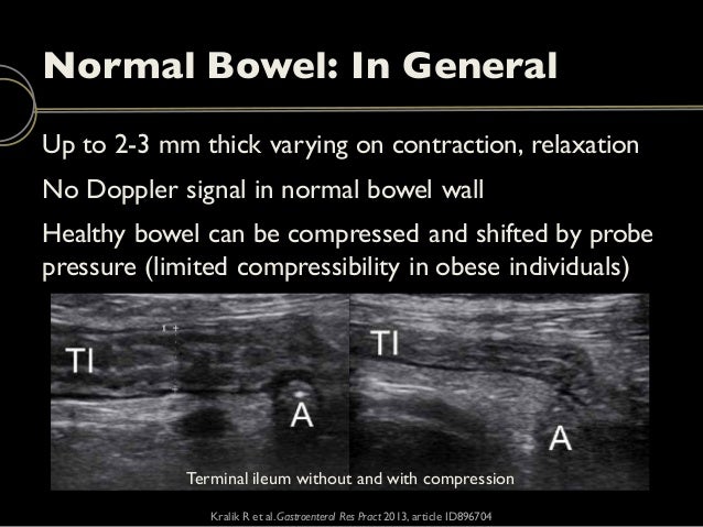Emergency Ultrasound: Bowel
