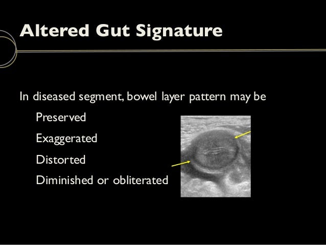 Emergency Ultrasound: Bowel