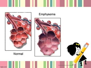 "Emfisema.ppt" | PPT