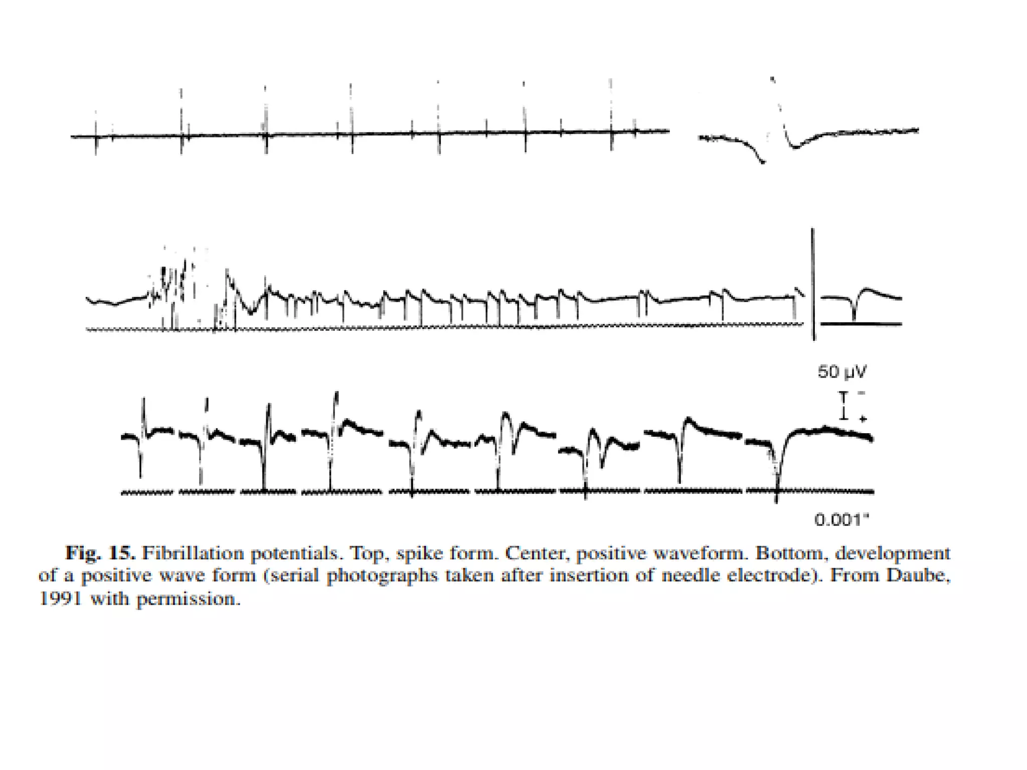 Emg | PDF