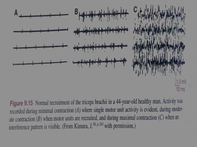 Emg | PDF | Brain and Nervous System Disorders | Diseases and Conditions