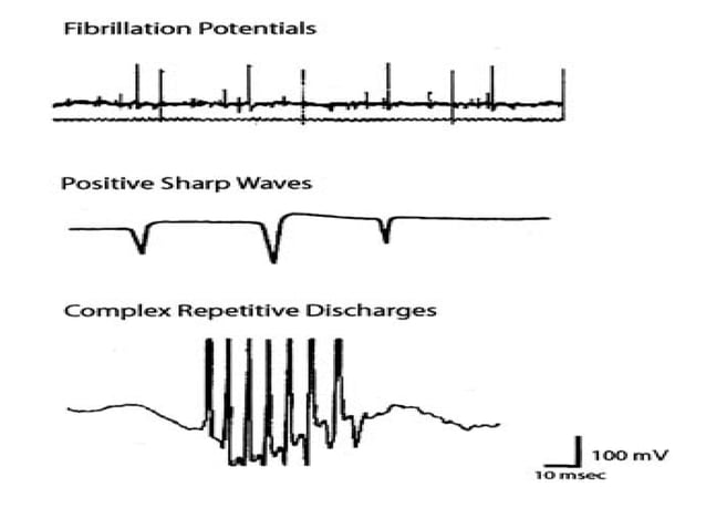Emg | PDF | Brain and Nervous System Disorders | Diseases and Conditions