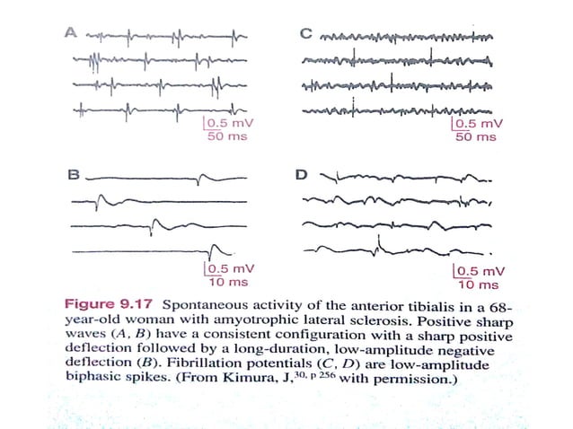 Emg | PDF | Brain and Nervous System Disorders | Diseases and Conditions