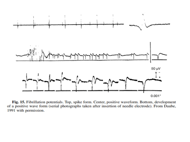 Emg | PDF | Brain and Nervous System Disorders | Diseases and Conditions