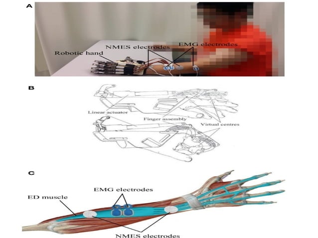 Emg | PDF | Brain and Nervous System Disorders | Diseases and Conditions