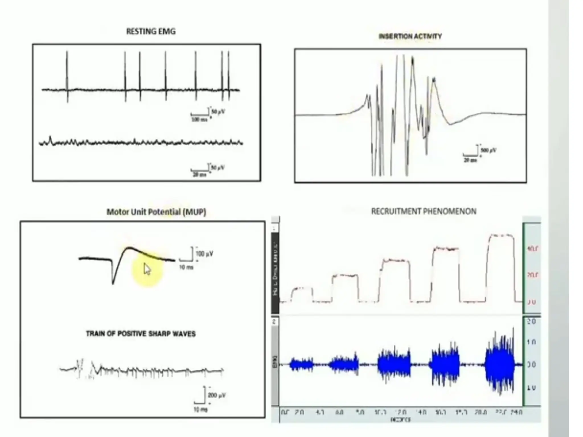 EMG CHANGES DURING FATIGUE & CONTRACTION.pptx