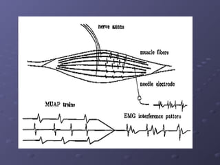 Emg fundamental | PPT | Brain and Nervous System Disorders | Diseases ...