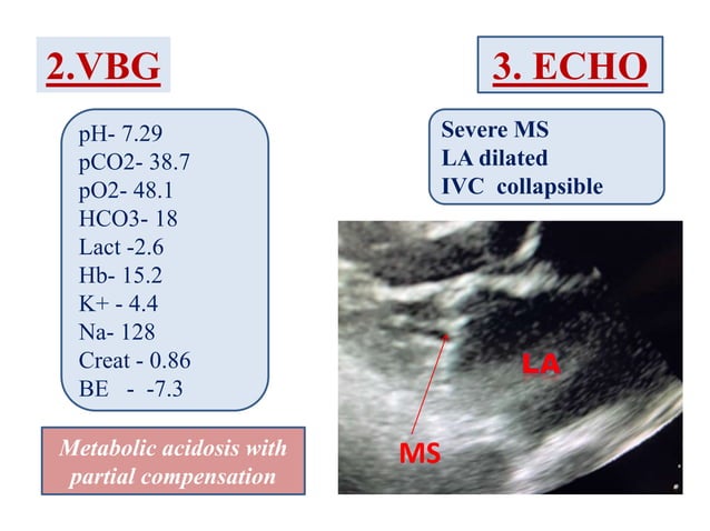 splenic infarct | PPT