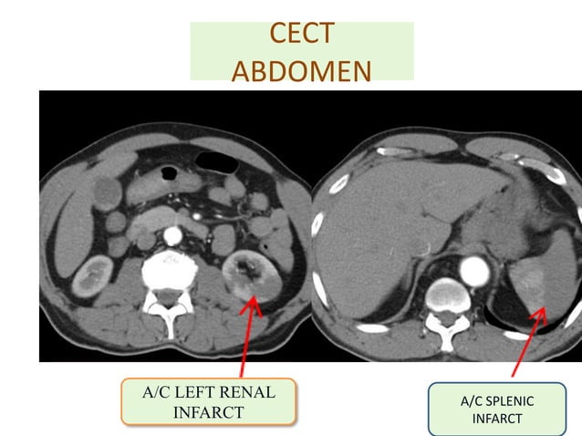 splenic infarct | PPT