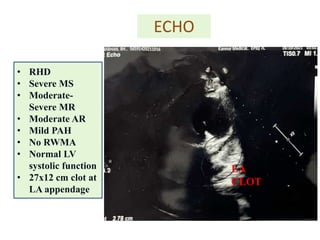 splenic infarct | PPT