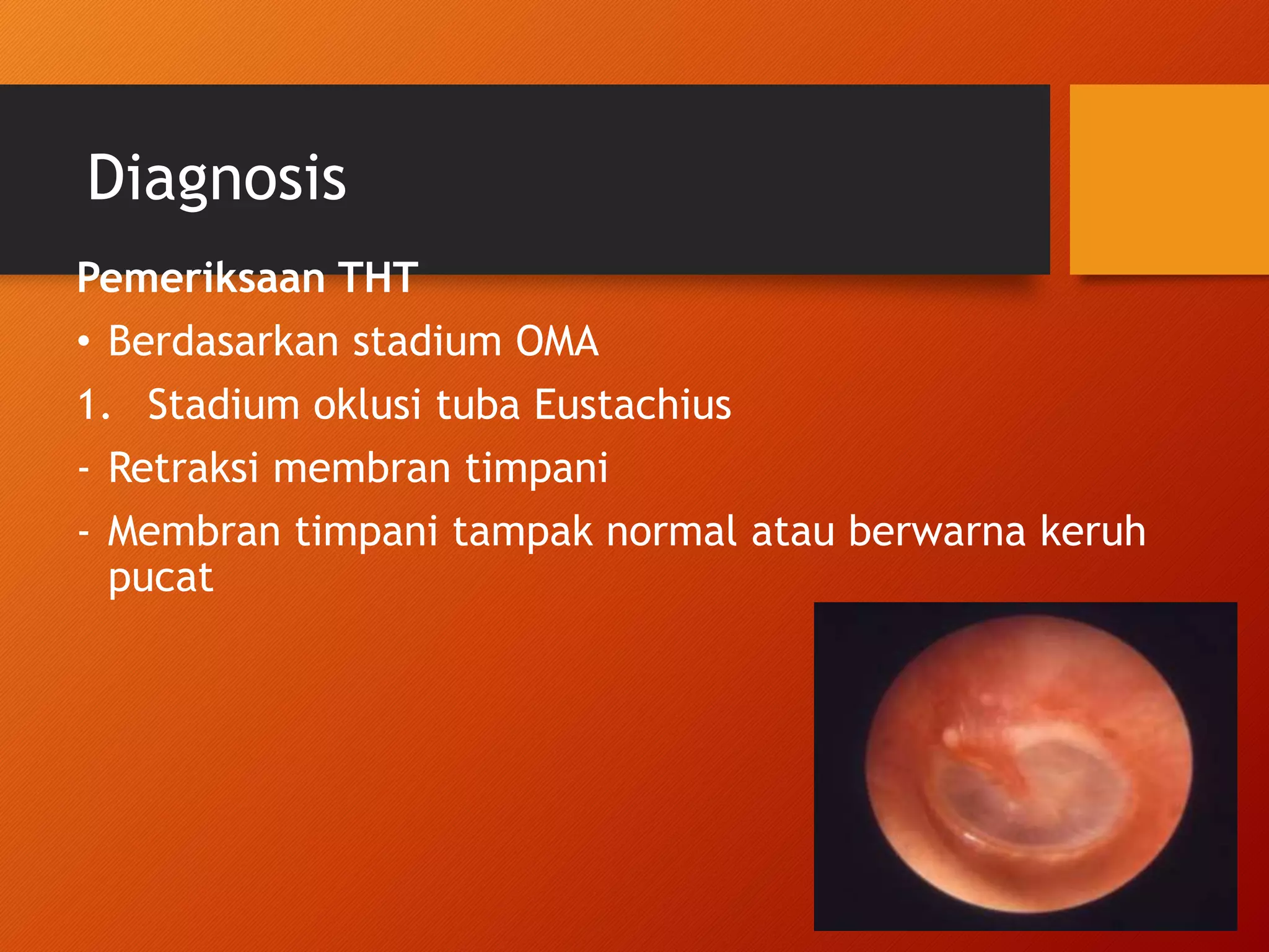 Otitis media akut | PPTX