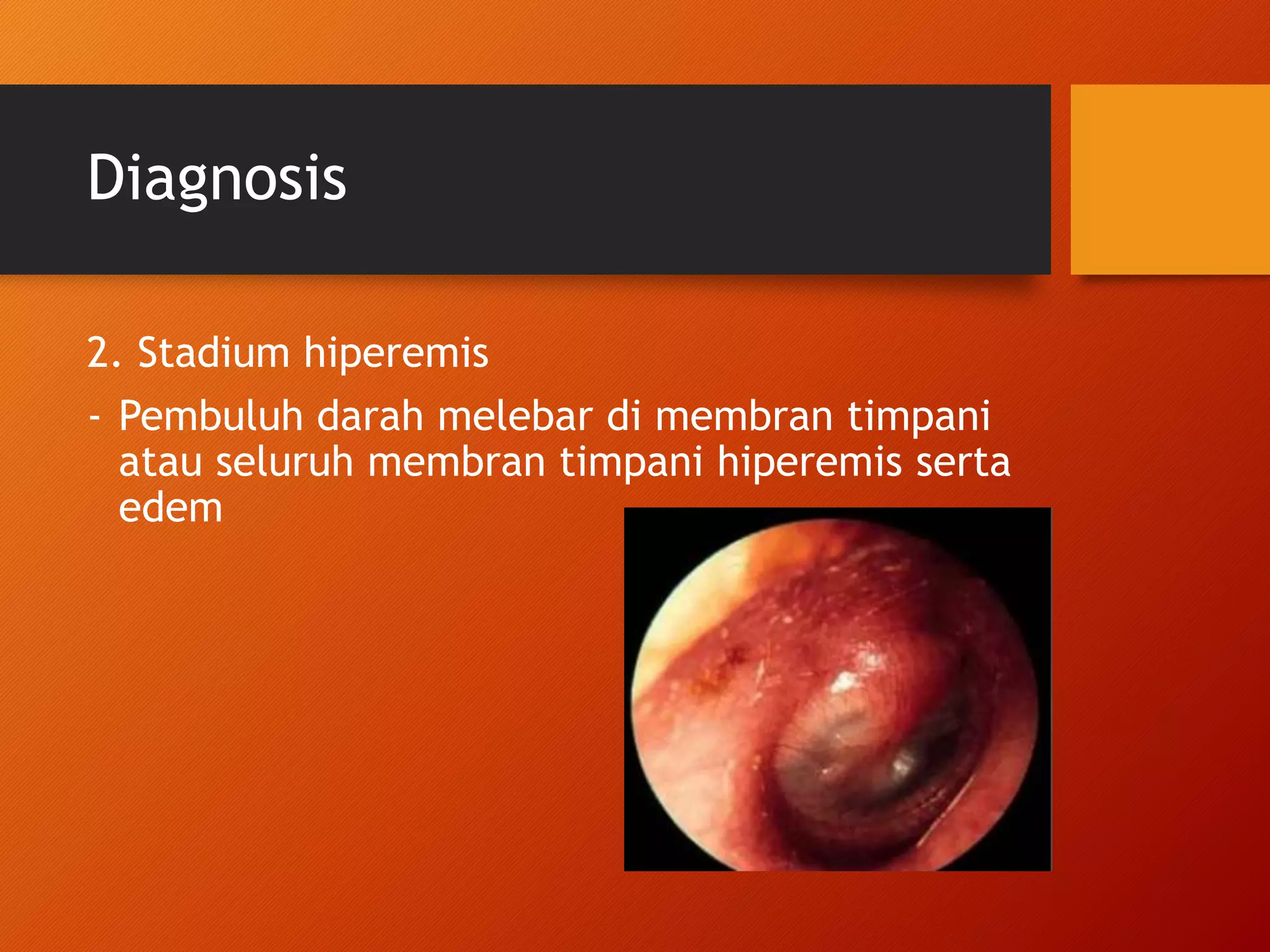 Otitis media akut | PPTX