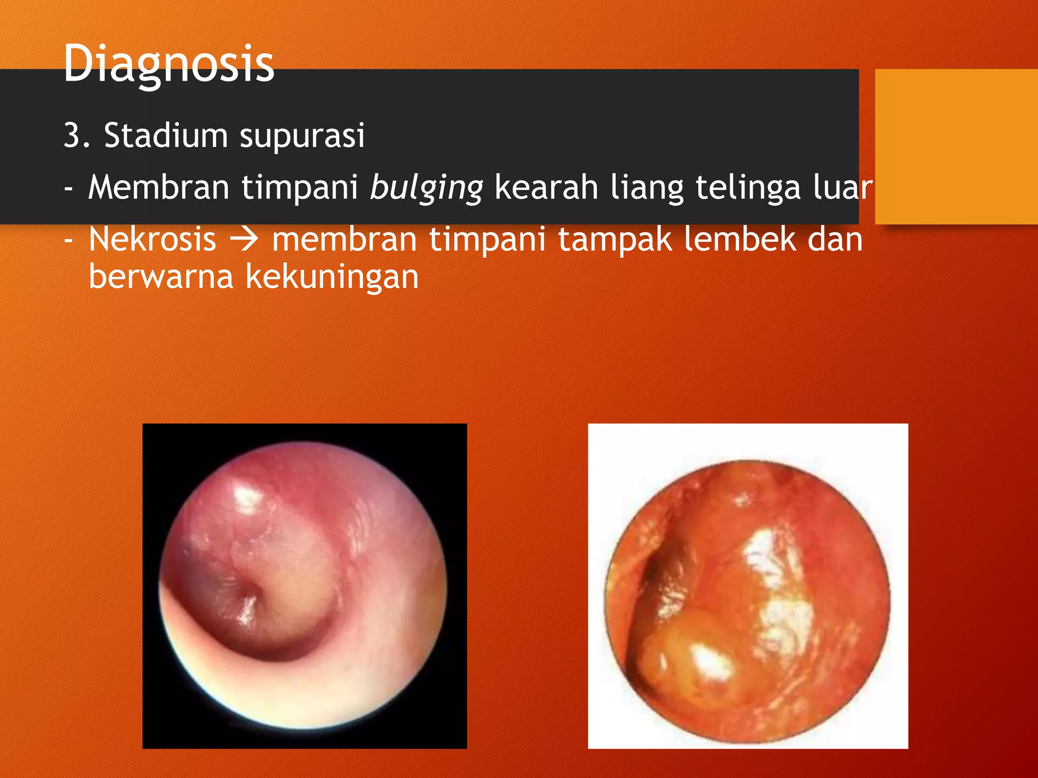 Otitis media akut | PPTX