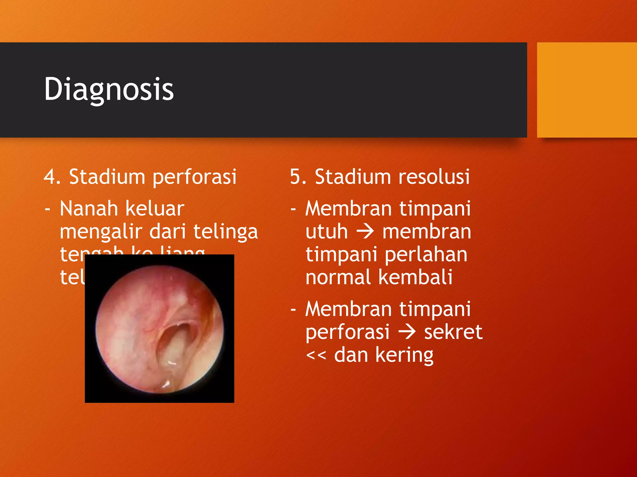 Otitis media akut | PPTX