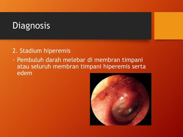 Otitis media akut | PPTX
